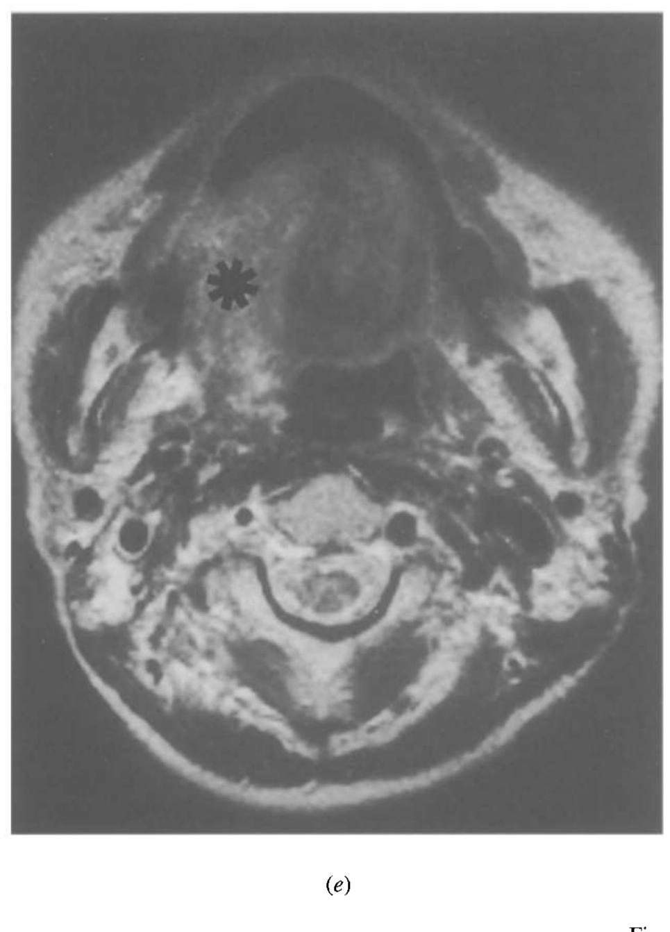 Figure 16 - Pictorial review: Radiology of the jugular