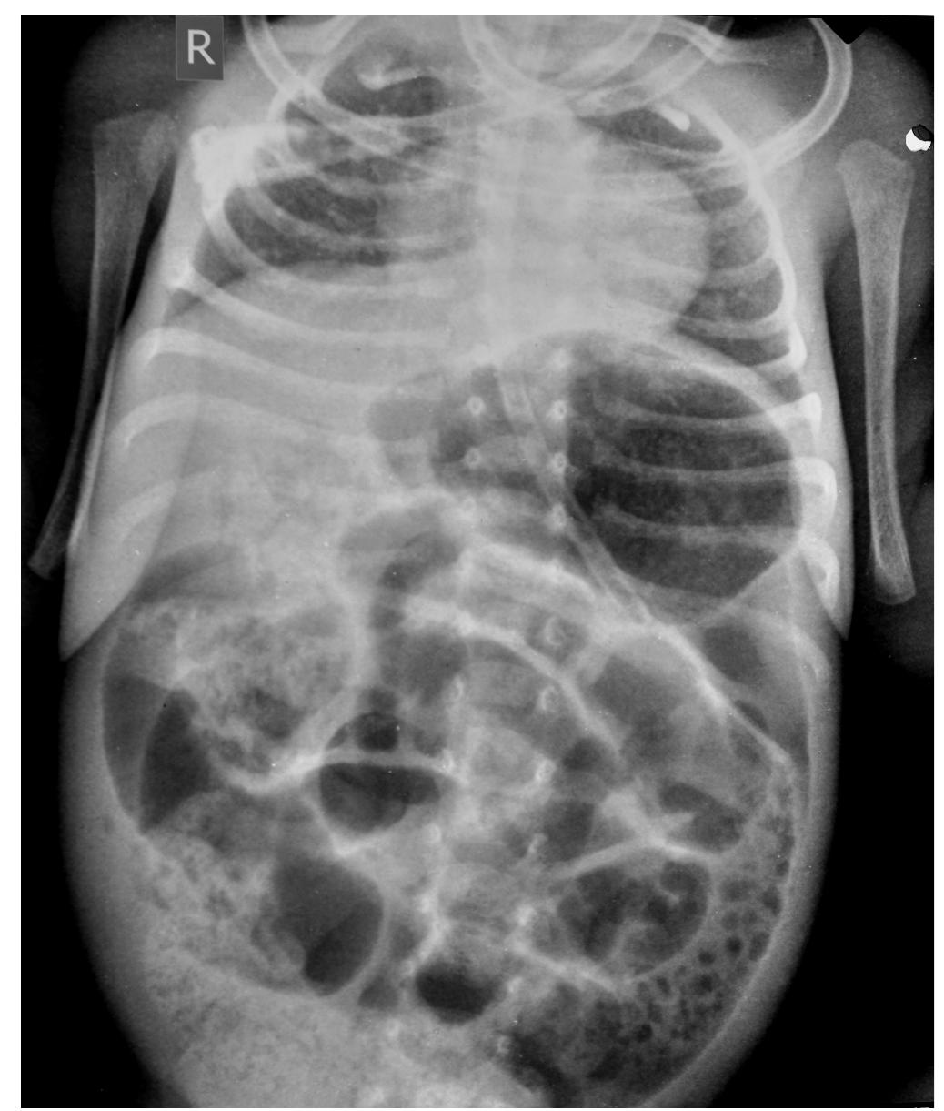 Straight x-ray abdomen showing dilated bowel loops with soap