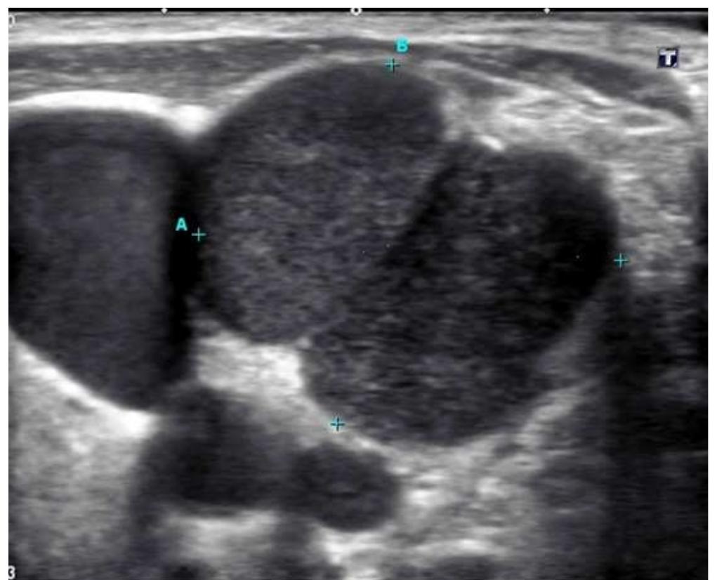 A: ultrasound image showing polylobulated, well-defined nod-