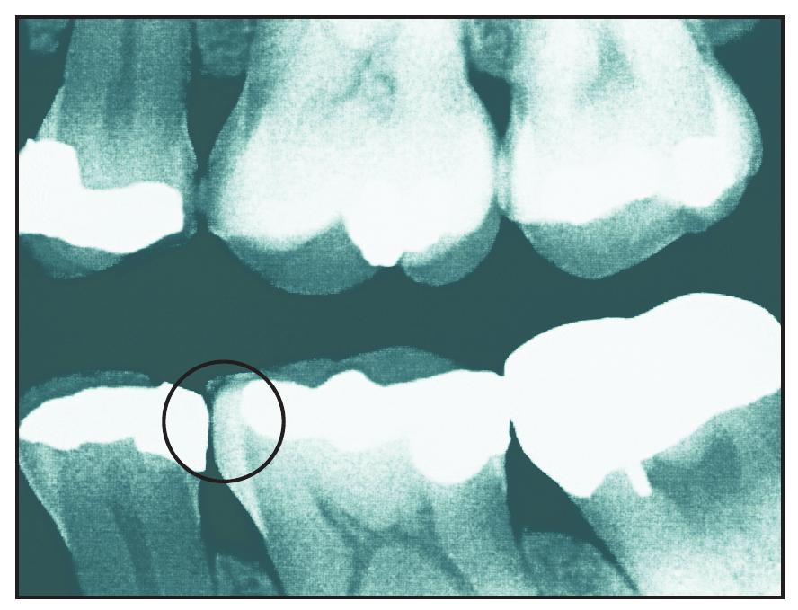 Radiograph of occlusal effect caries associated with the