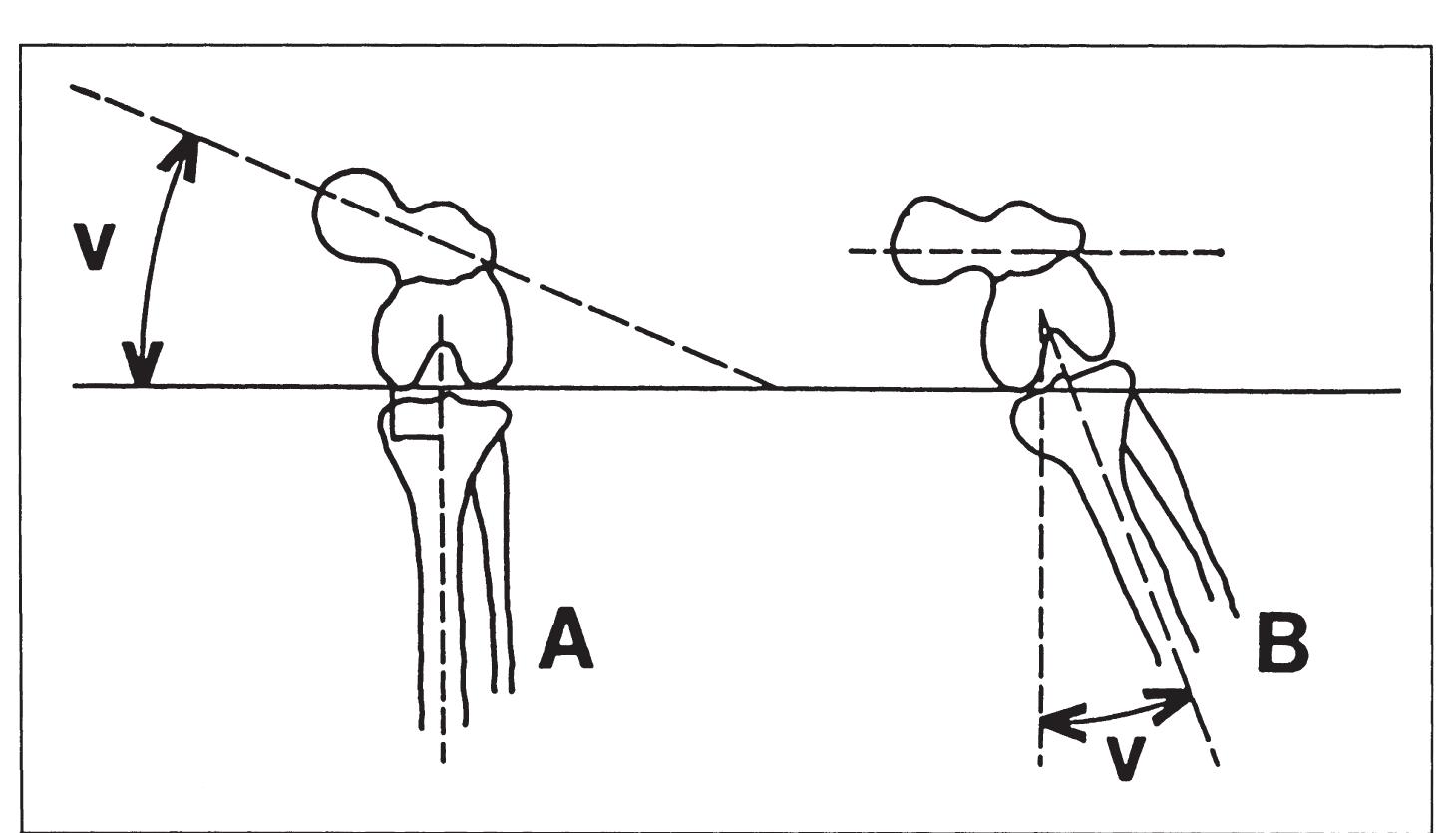 Skeletal representation of ryder’s test in context of