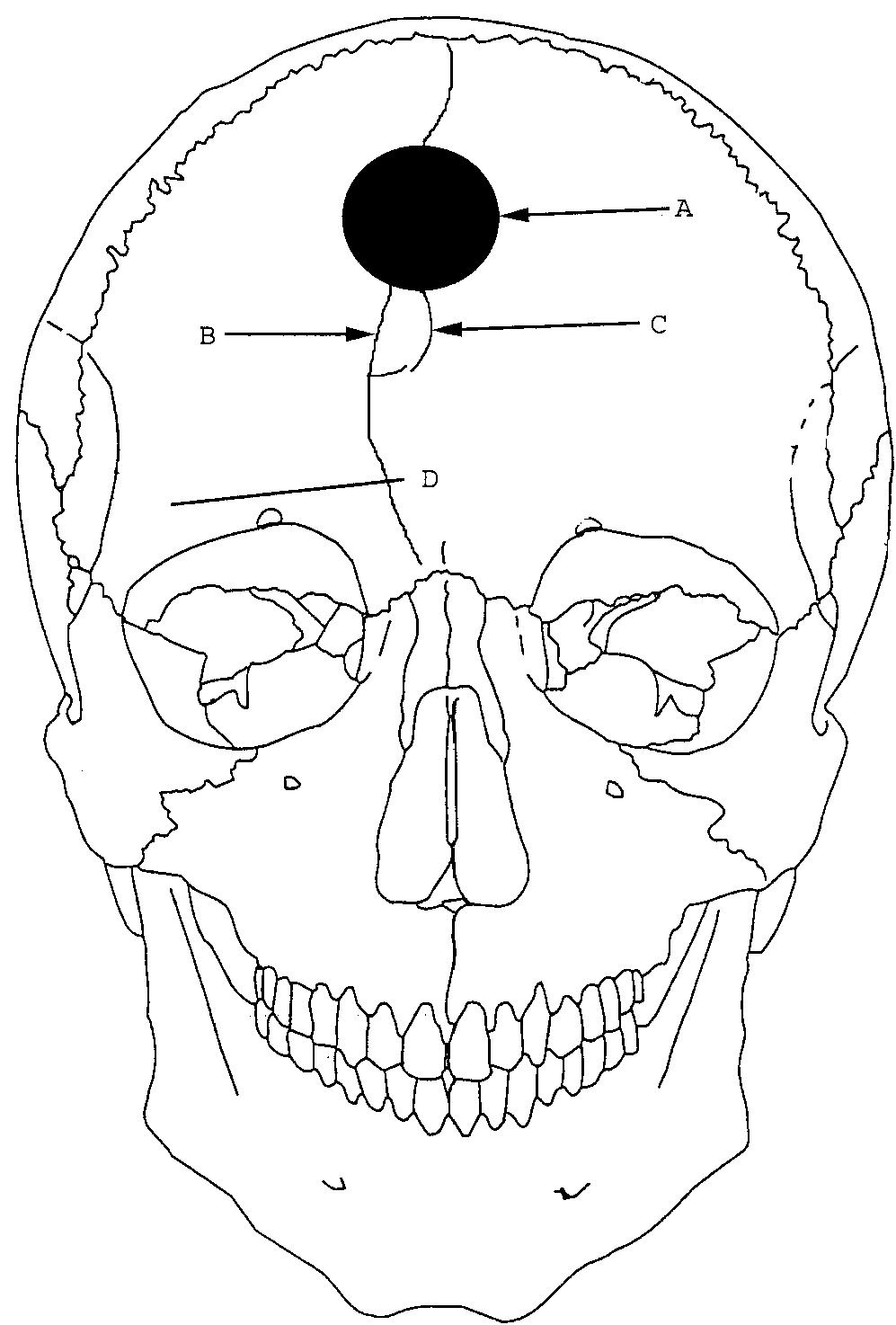 Diagram illustrating lesions on frontal bone of burial 85-8.