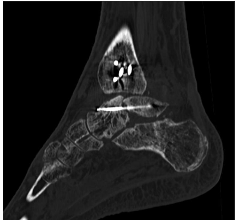 This sagittal computed tomography view of the ankle