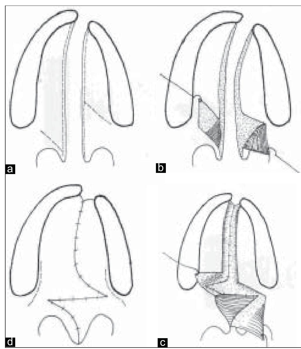 Figure 4 - from Cleft palate repair and variations