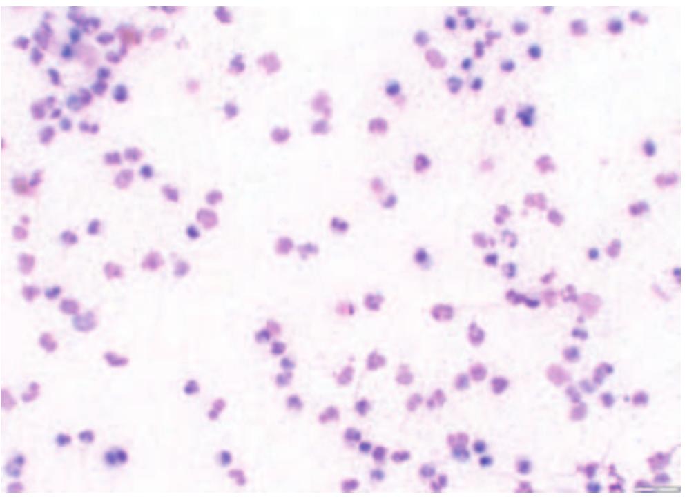 Peritoneal fluid sample, direct smear (200x). mark- edly