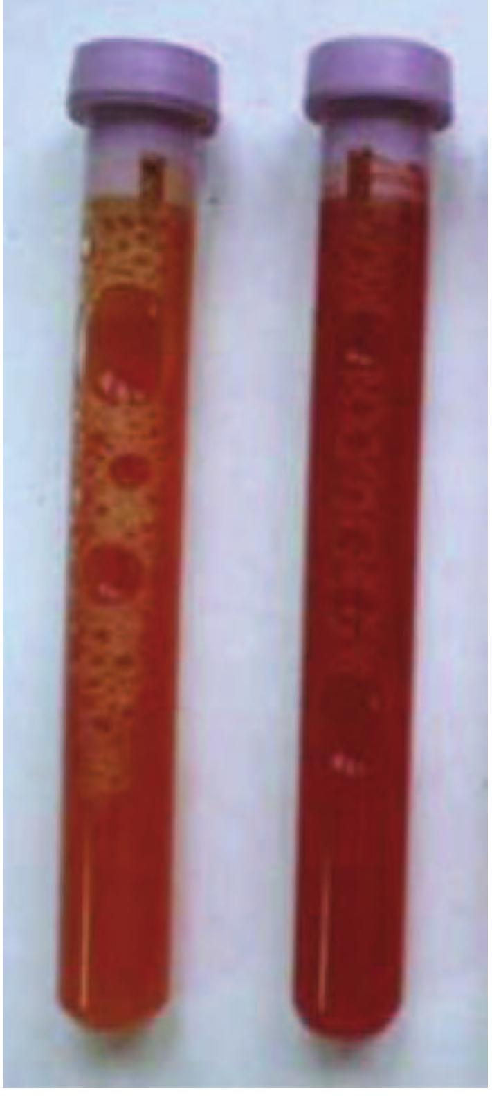 Serosanguinous pleural fluid from a horse with cranial