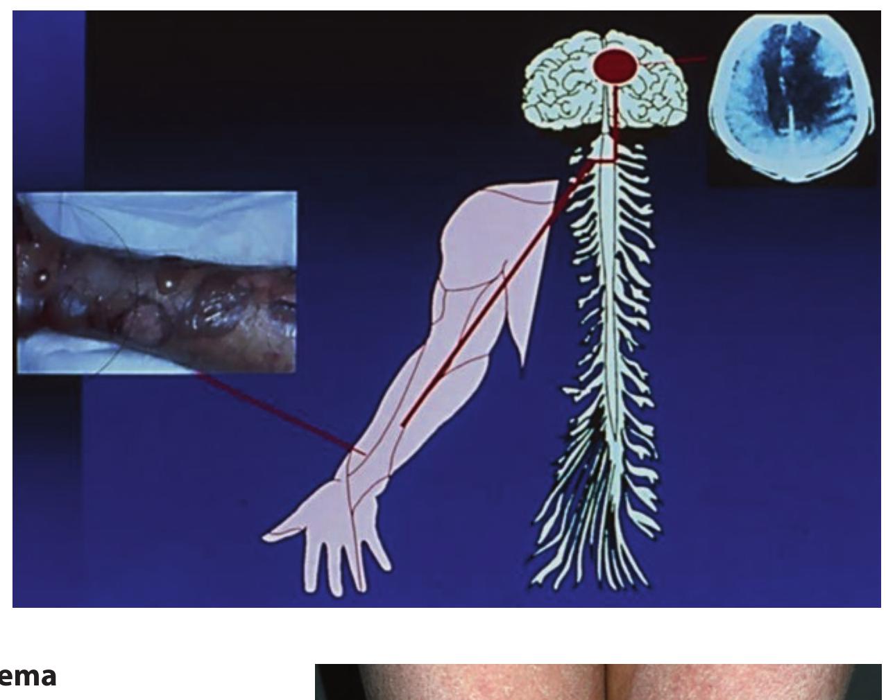 Erythema nodosum is a skin reaction manifested by tender or