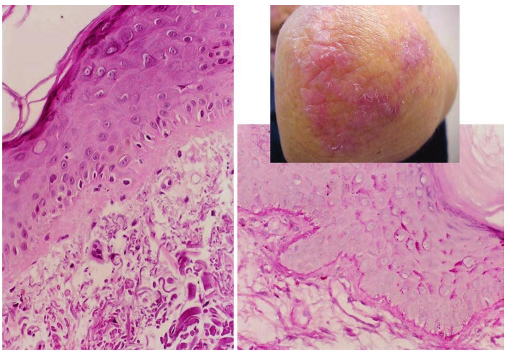 36 interface dermatitis on elbow of a patient under