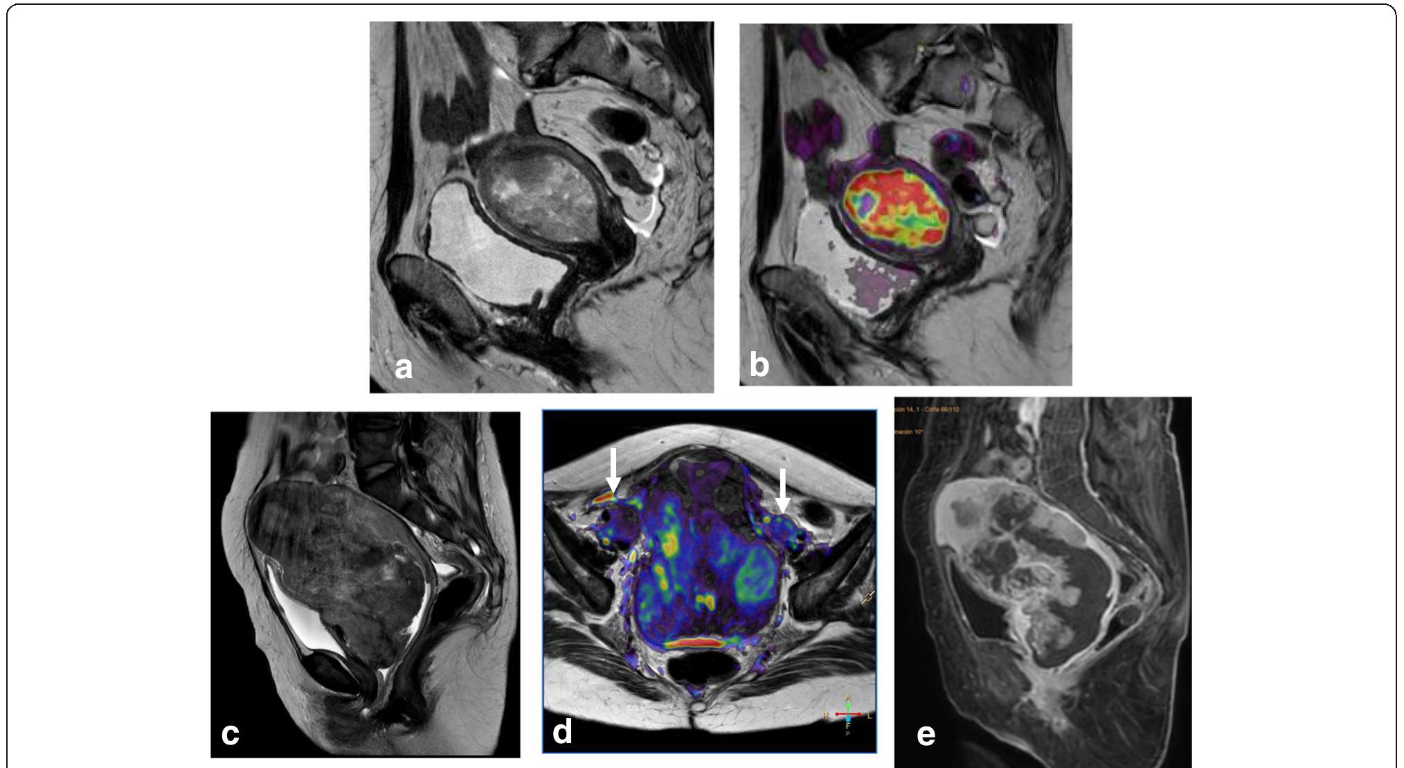 Endometrial-based tumor visualized with sagittal t2wi (a)