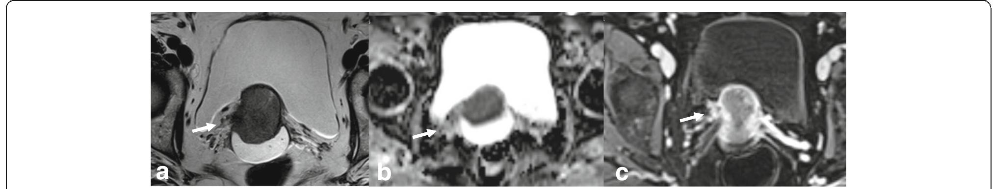 Tumor visualization with axial oblique t2wi (a), dwi-adc map