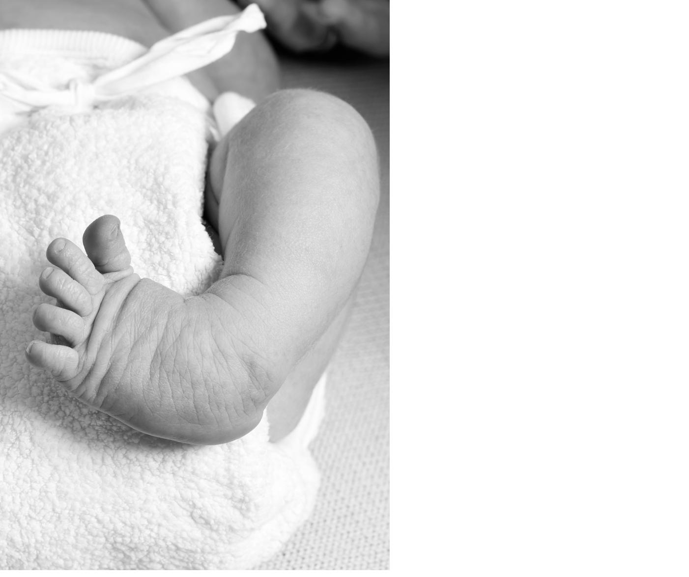 Example of clubfoot with rounded lateral border. figure