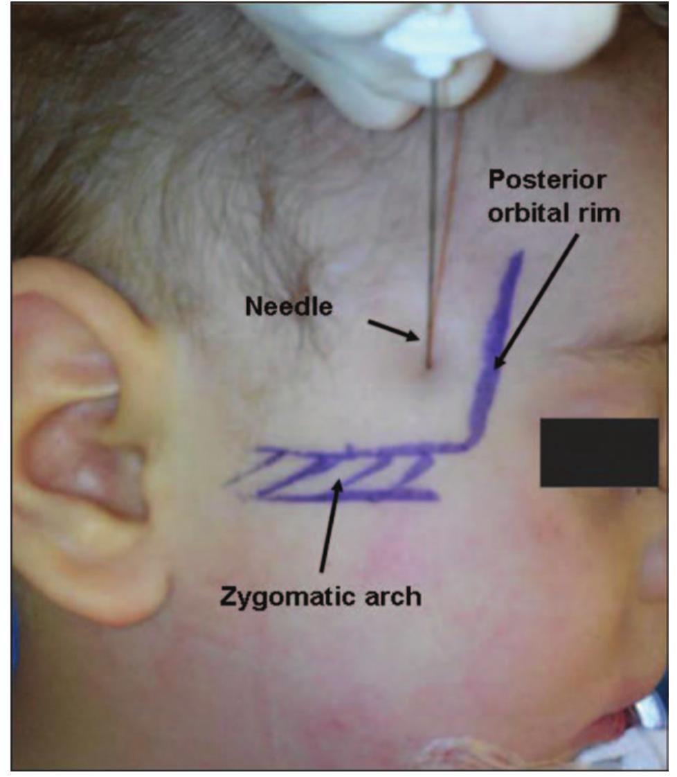 Suprazygomatic maxillary nerve block landmarks. the needle