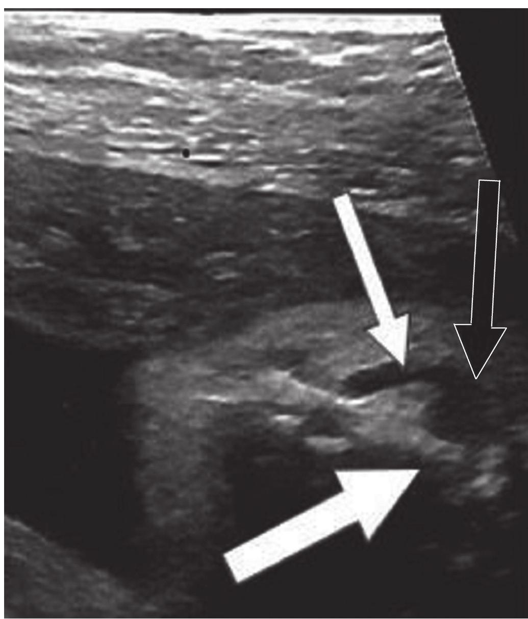 Sagittal view of the right tmj; mouth was closed and right