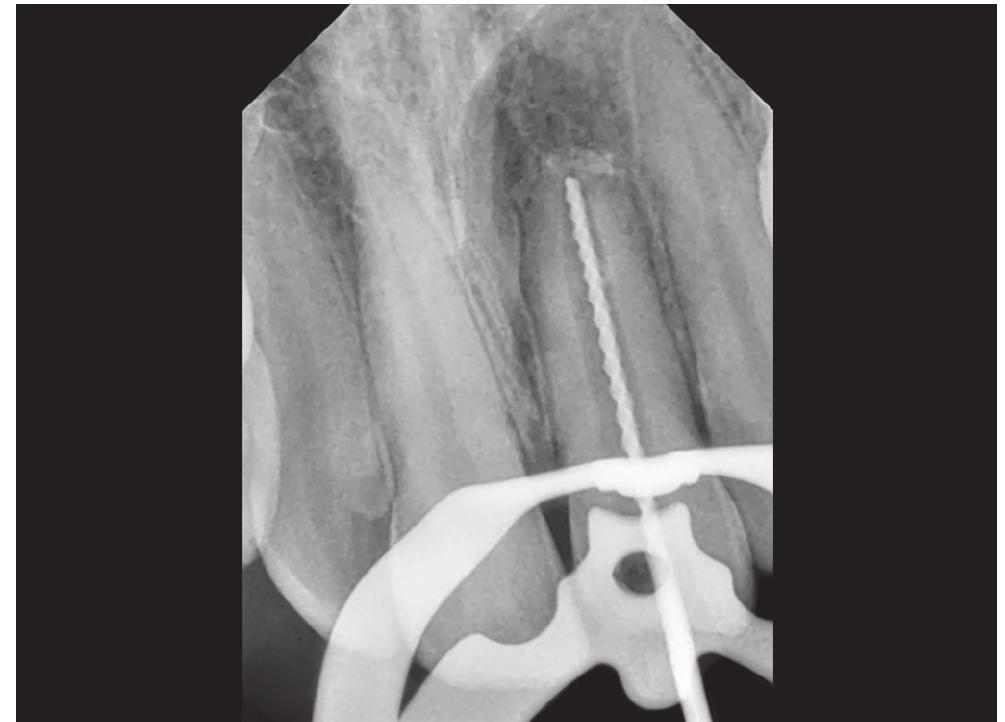 Figure 2 - Endodontic Management of Tooth with Open Apex