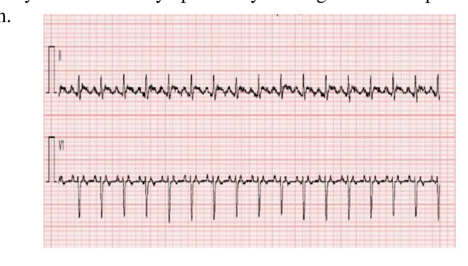 Atrial flutter is a type of supraventricular tachycardia