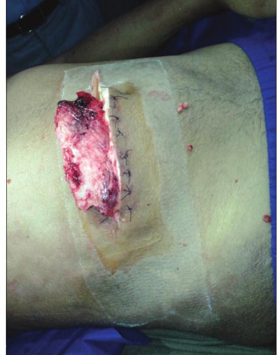 Figure 4 - Skull bone flap preserved in anterior abdominal