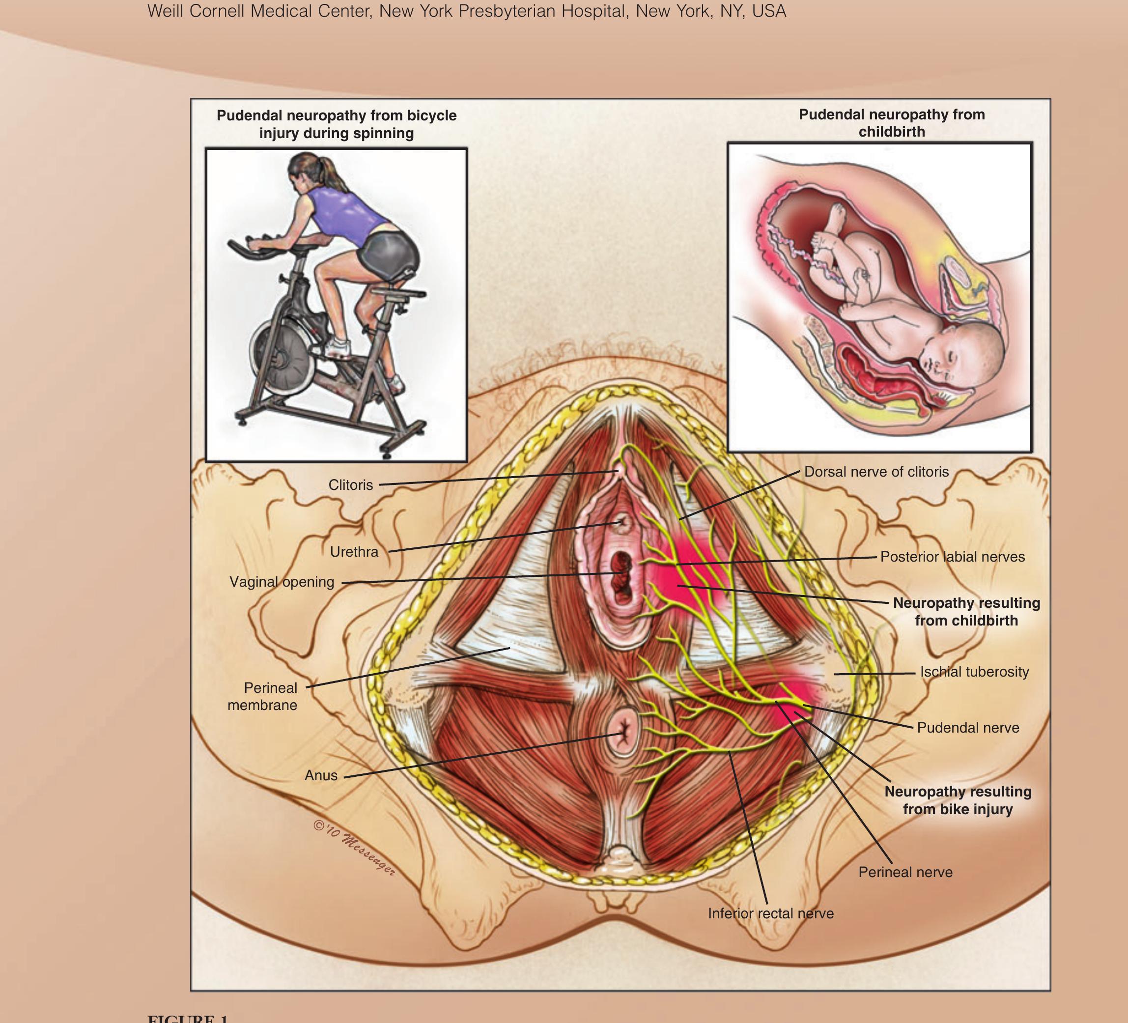 Figure 1 - Techniques of Pudendal Nerve Block