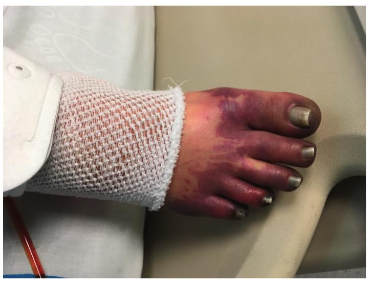 Purpura fulminans: haemorrhagic necrosis of the skin in the