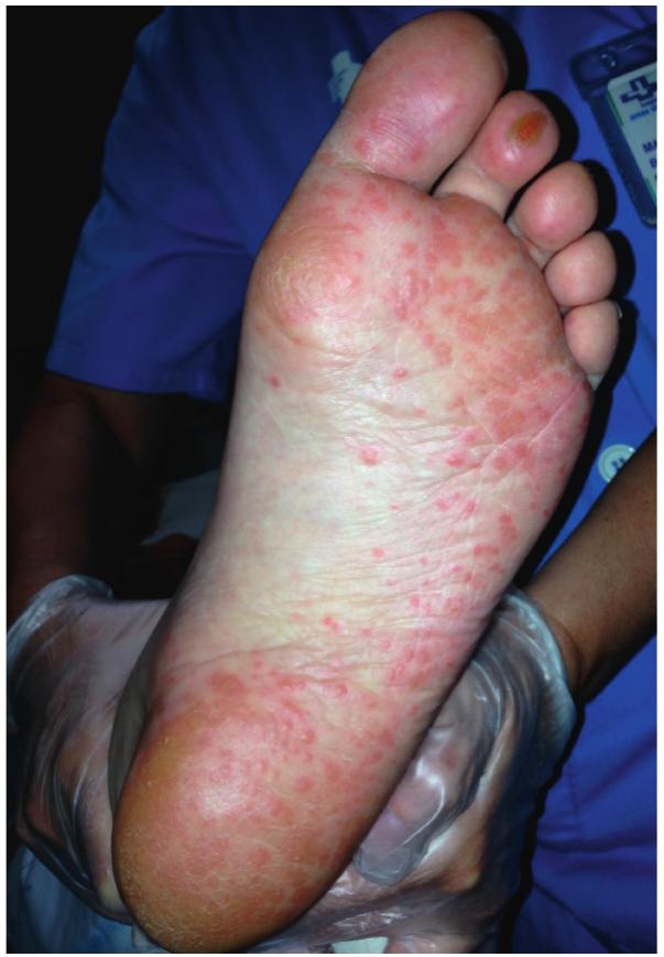 Ficure 6: secondary syphilis: maculopapular lesions on