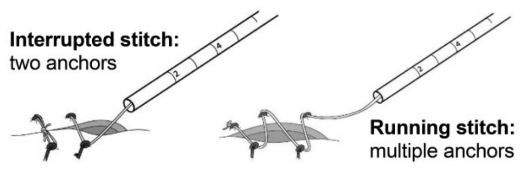 |. illustration of suturing with the su2ura approximation