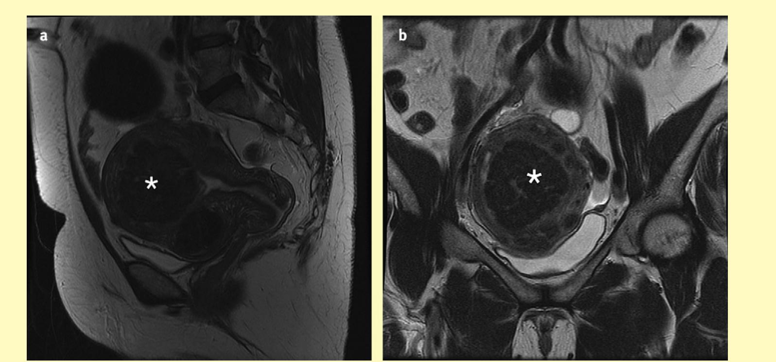 Sagittal and axial t2wi magnetic resonance image of large