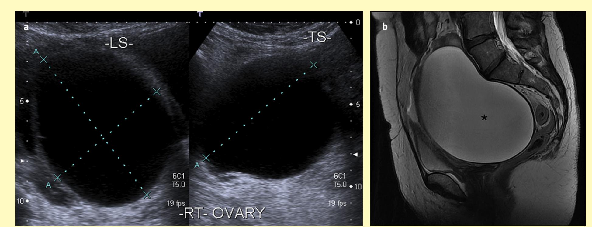 A ultrasound showing a large simple ovarian cyst. b t2wi