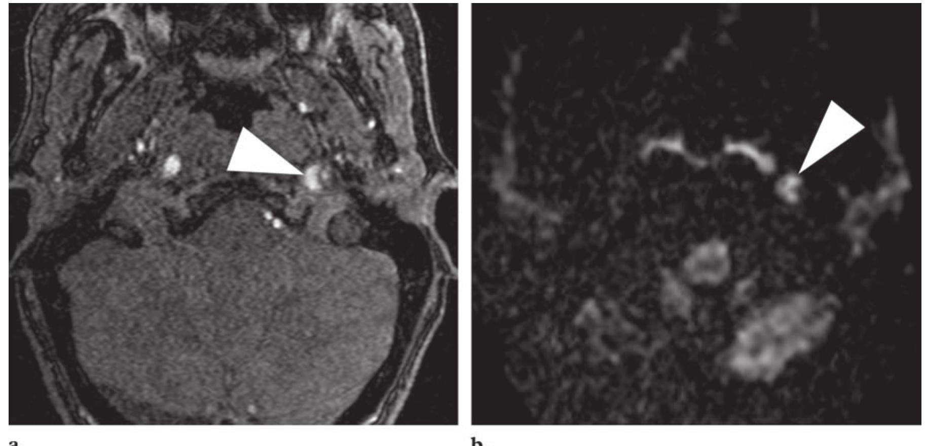 Subacute dissection of the left ica in a 55-year-old woman.