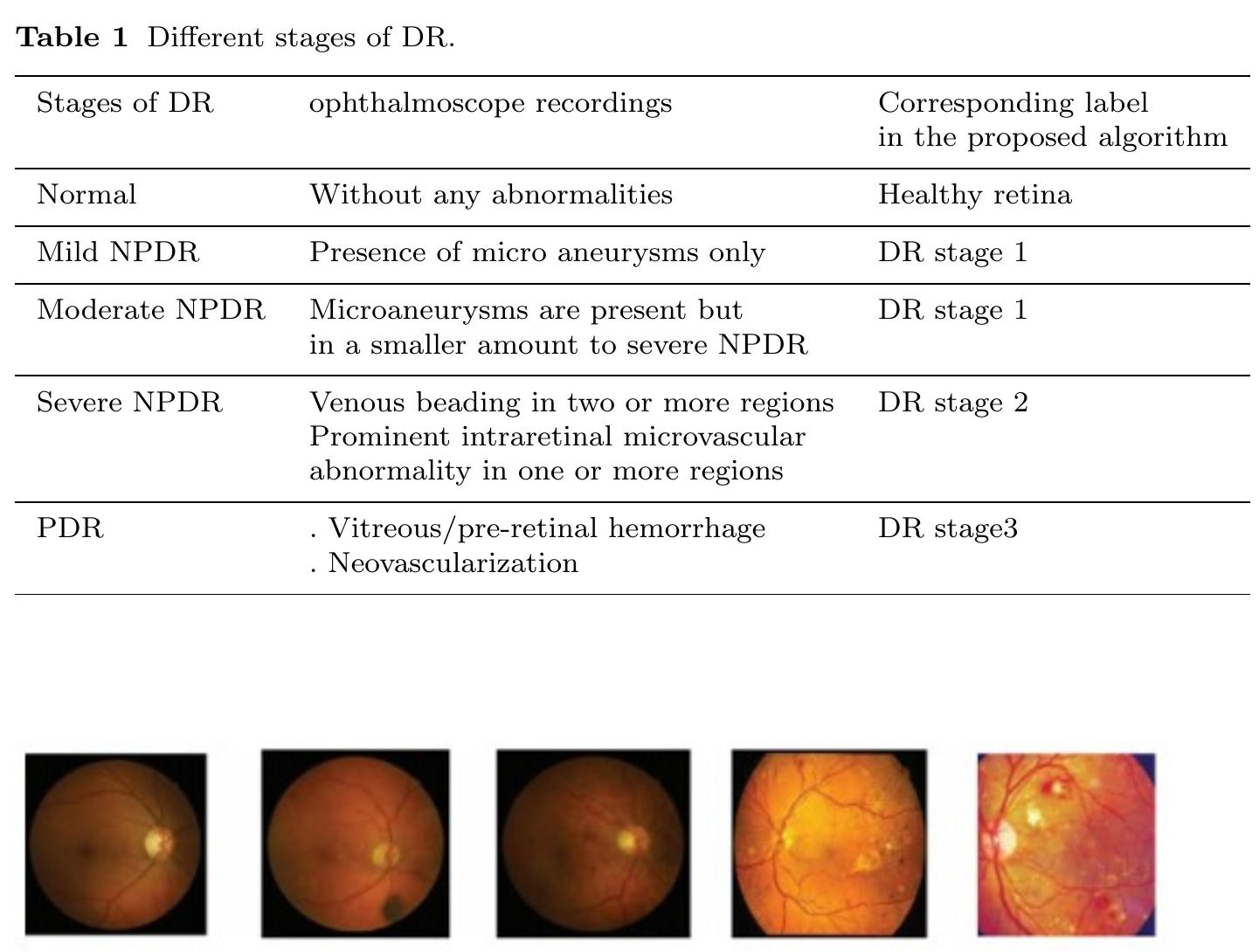 Stages of dr starting from healthy fundus image[25] the
