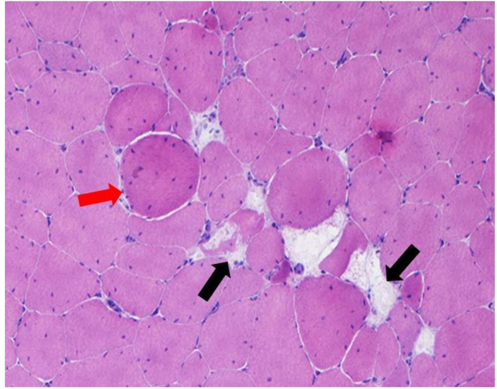 Ross 308 pectoralis major with muscle fibers necrosis (black