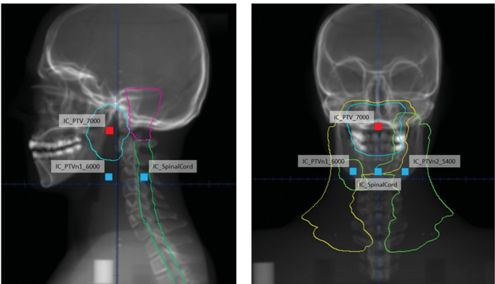 Anterior and lateral projections of the shane phantom and