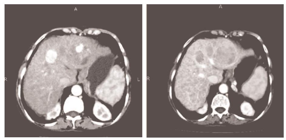 Figure 2 - from Triphasic computed tomography (CT) scan in