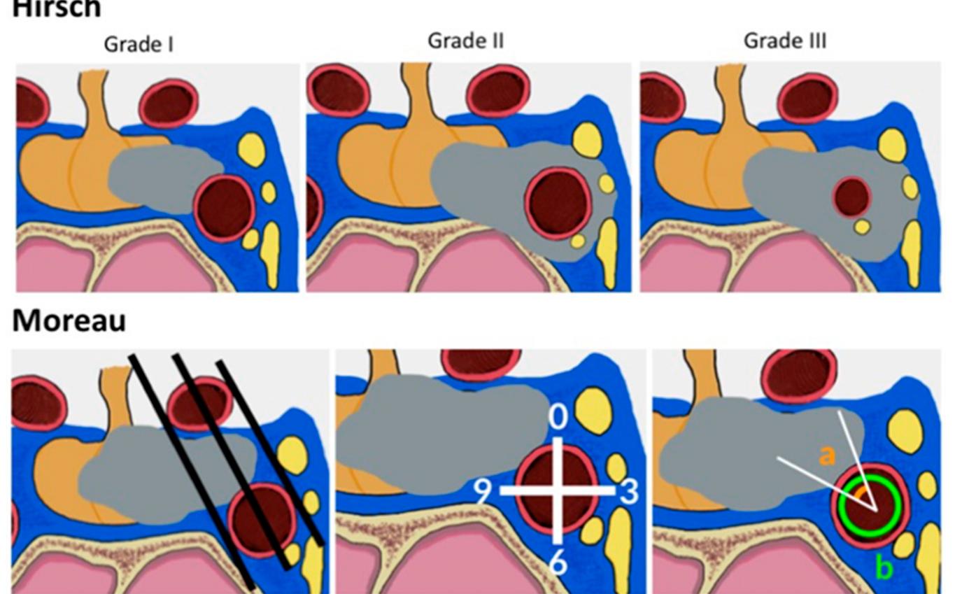 Summary of radiological criteria of cavernous sinus (cs)