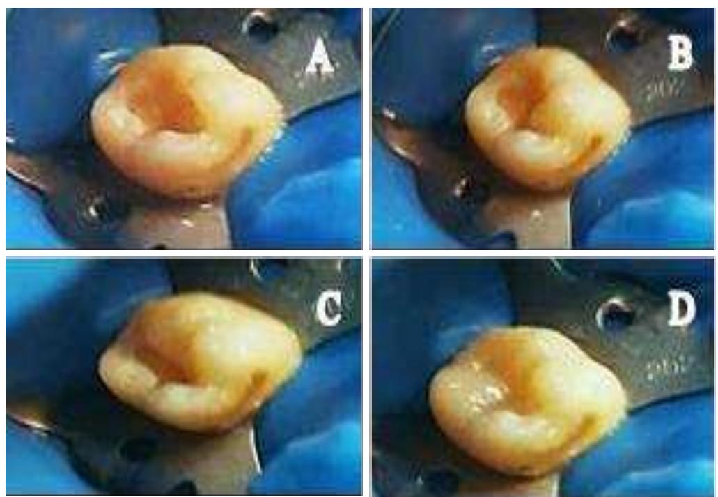 The pizza technique procedure starts from the mesiobuccal