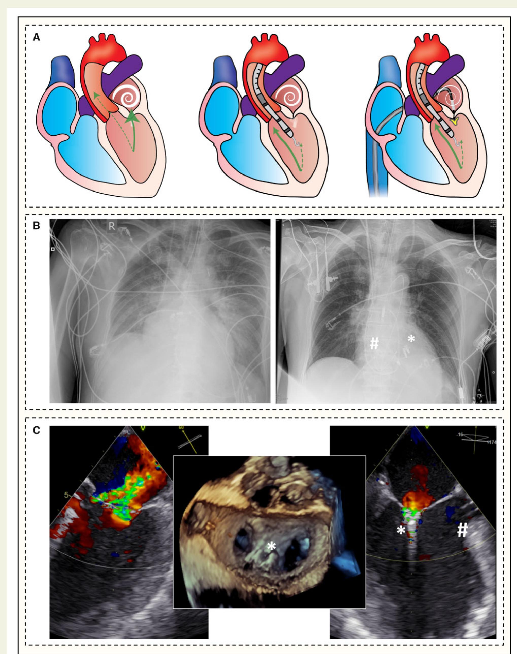 | impella®-cp as bridge from acute severe mitral