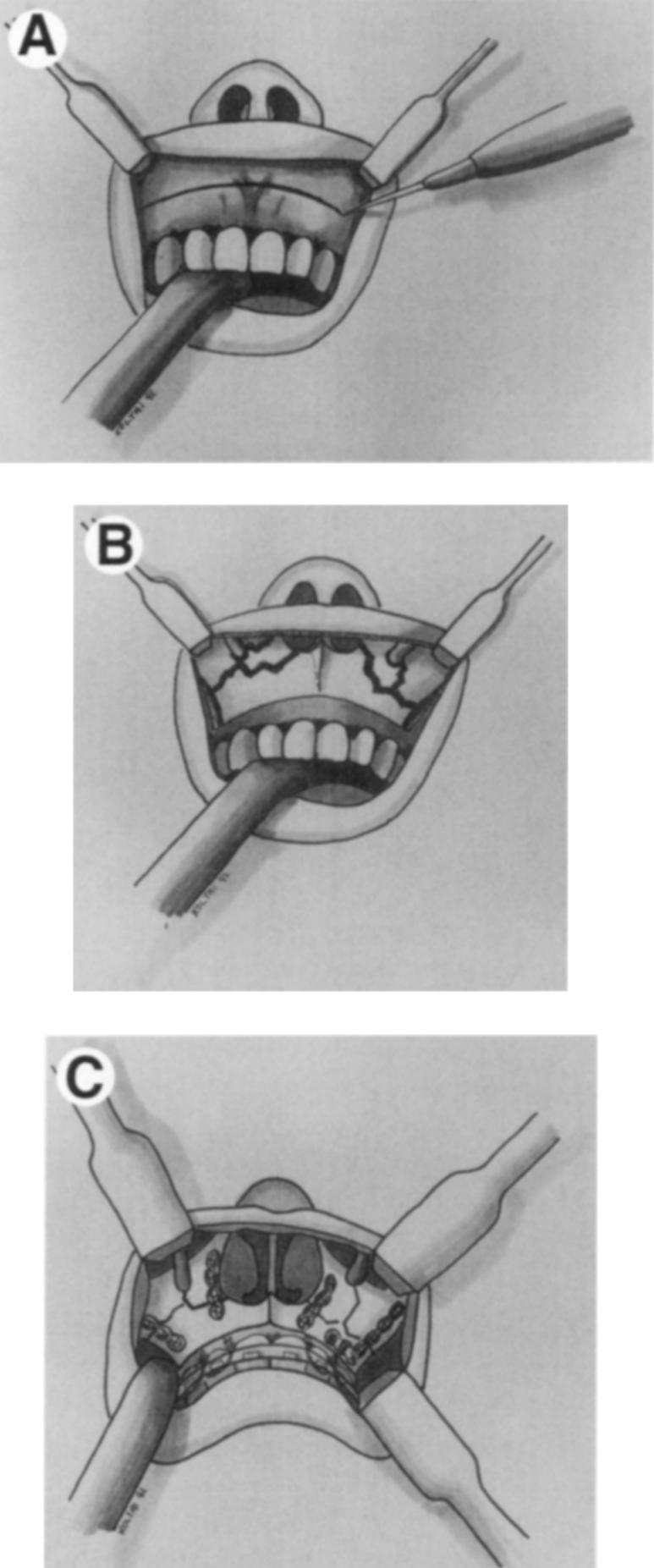 (a) using needle cautery a maxillary gingivolabial sulcus