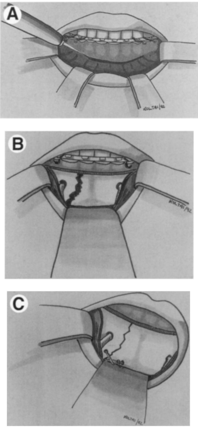 (a) mandibular gingivolabial sulcus incision for a transoral