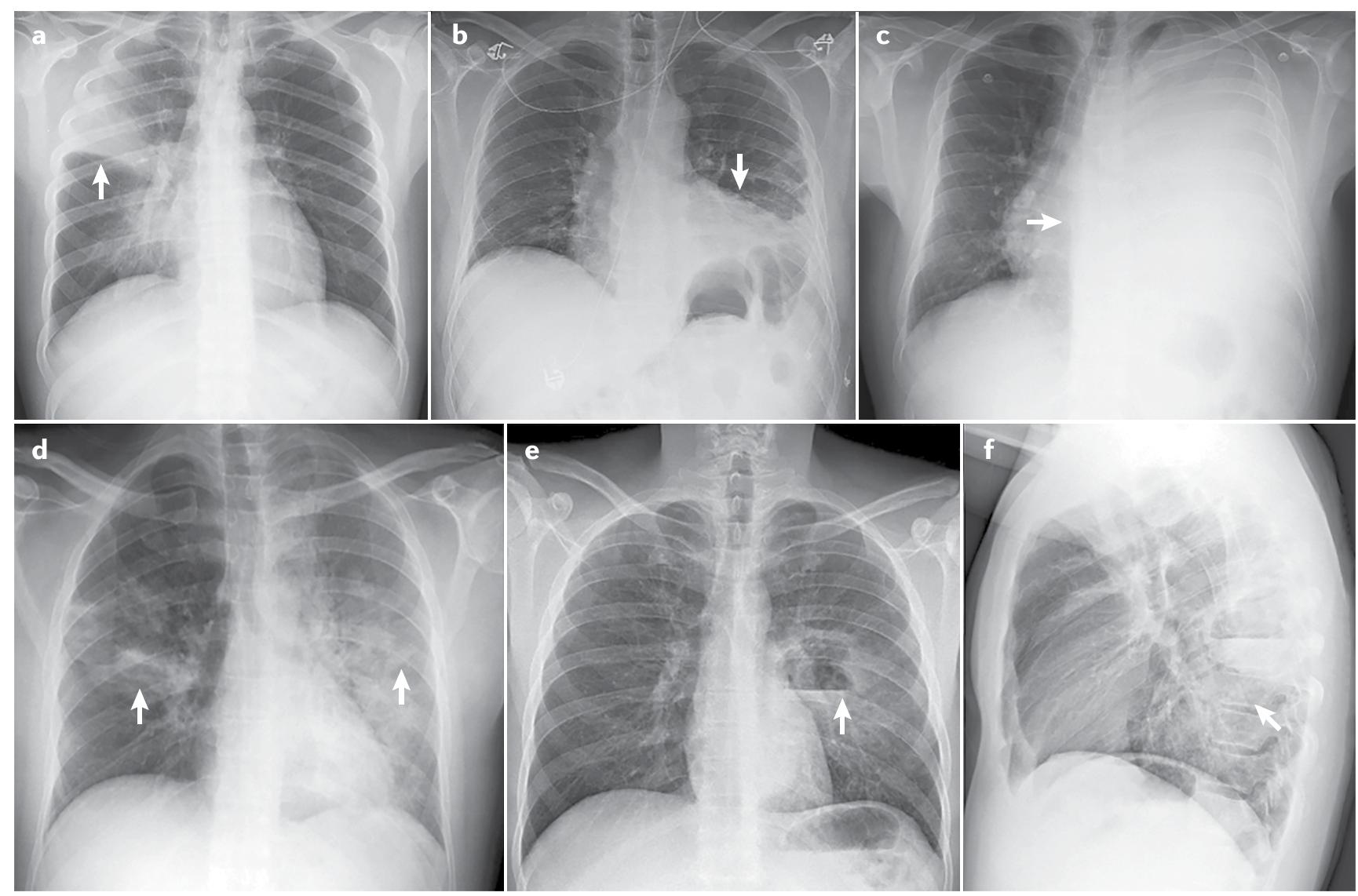 | associated features of pneumonia on plain radiography.