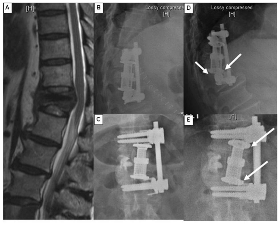 (a) spinal metastases to t12 from lungs(56 yrs/female). (b