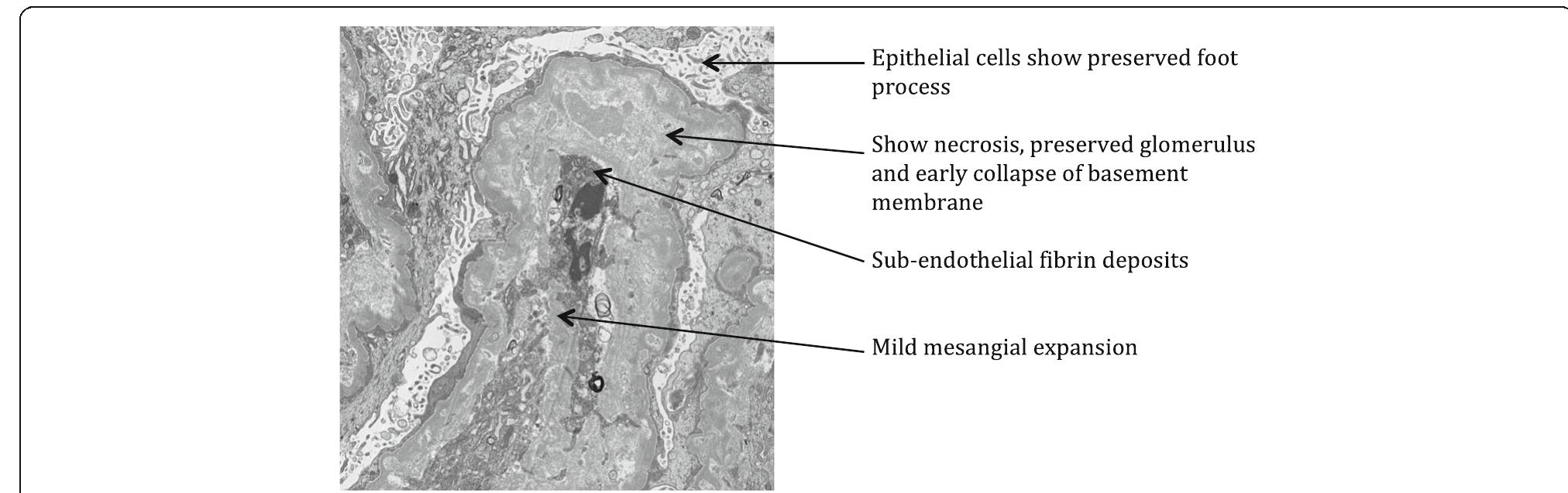 Renal biopsy showing preserved foot process and glomerulus