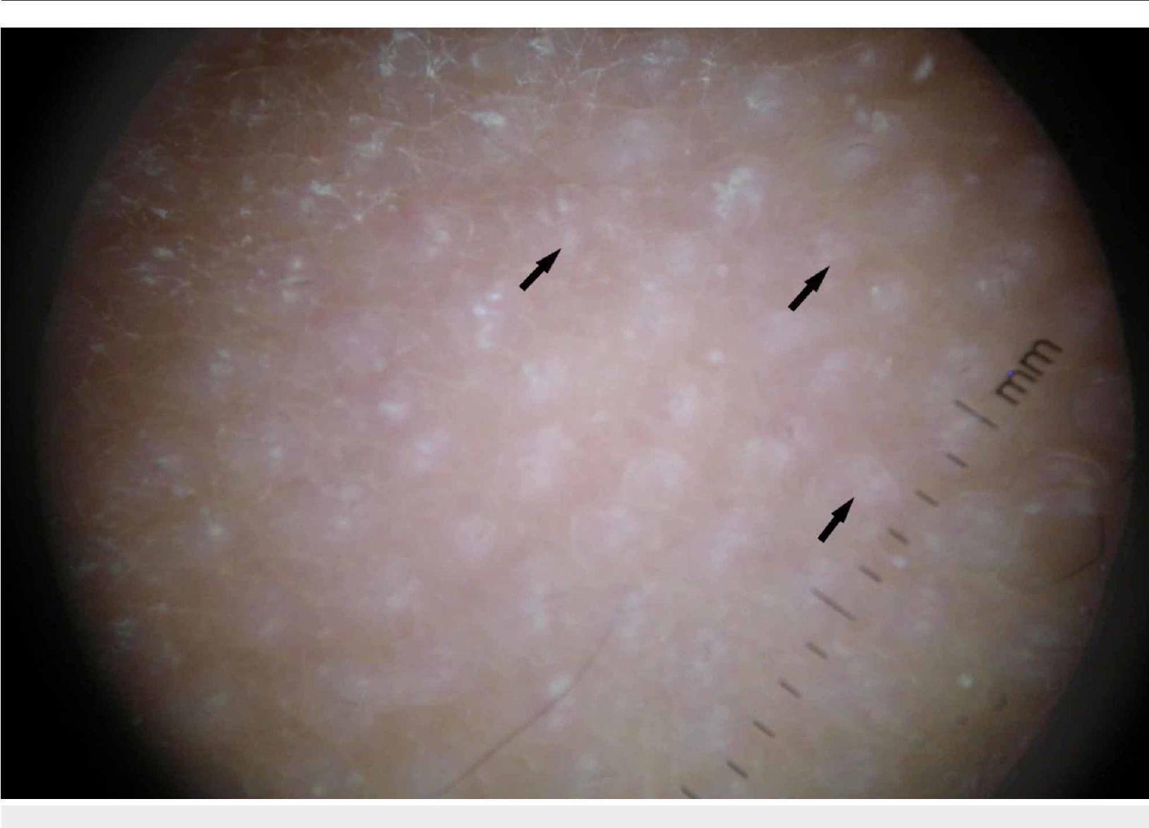 Dermatoscope view showing multiple papular lesions (arrows)