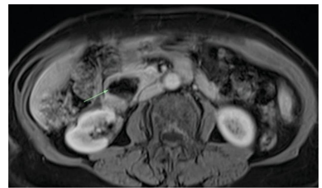 Axial t1i-weighted mri of abdomen showing the periampullary
