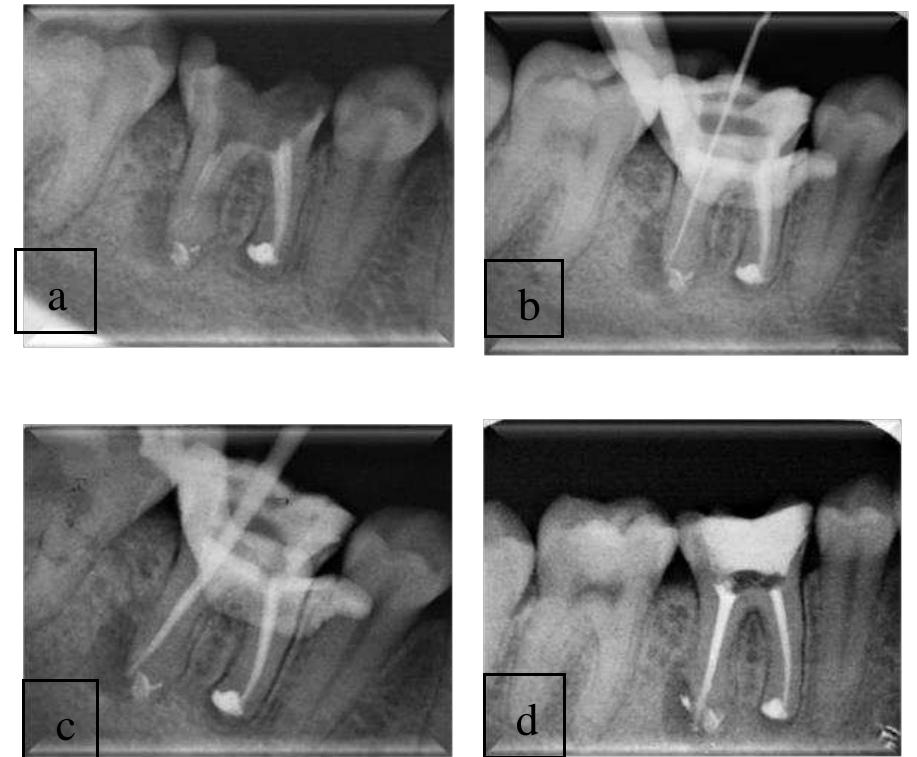 Periapical radiograh of tooth 46 (a) radiographic view after