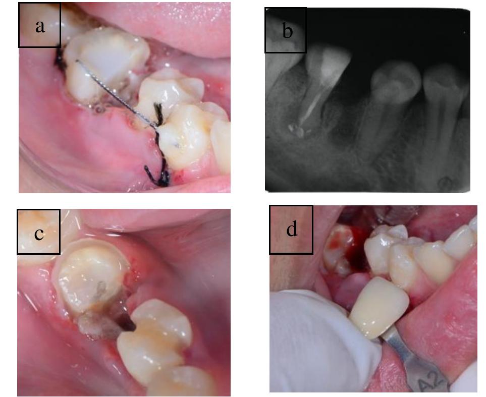 (a) temporary splinting, (b) radiographic view of 1 week