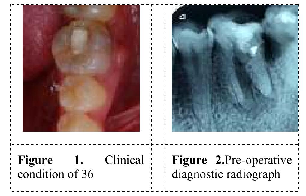 Figure 1 - Bicuspidization of a Mandibular First Molar With