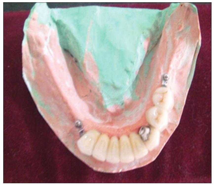 Figure 7 - from Attachment Retained Cast Partial Denture