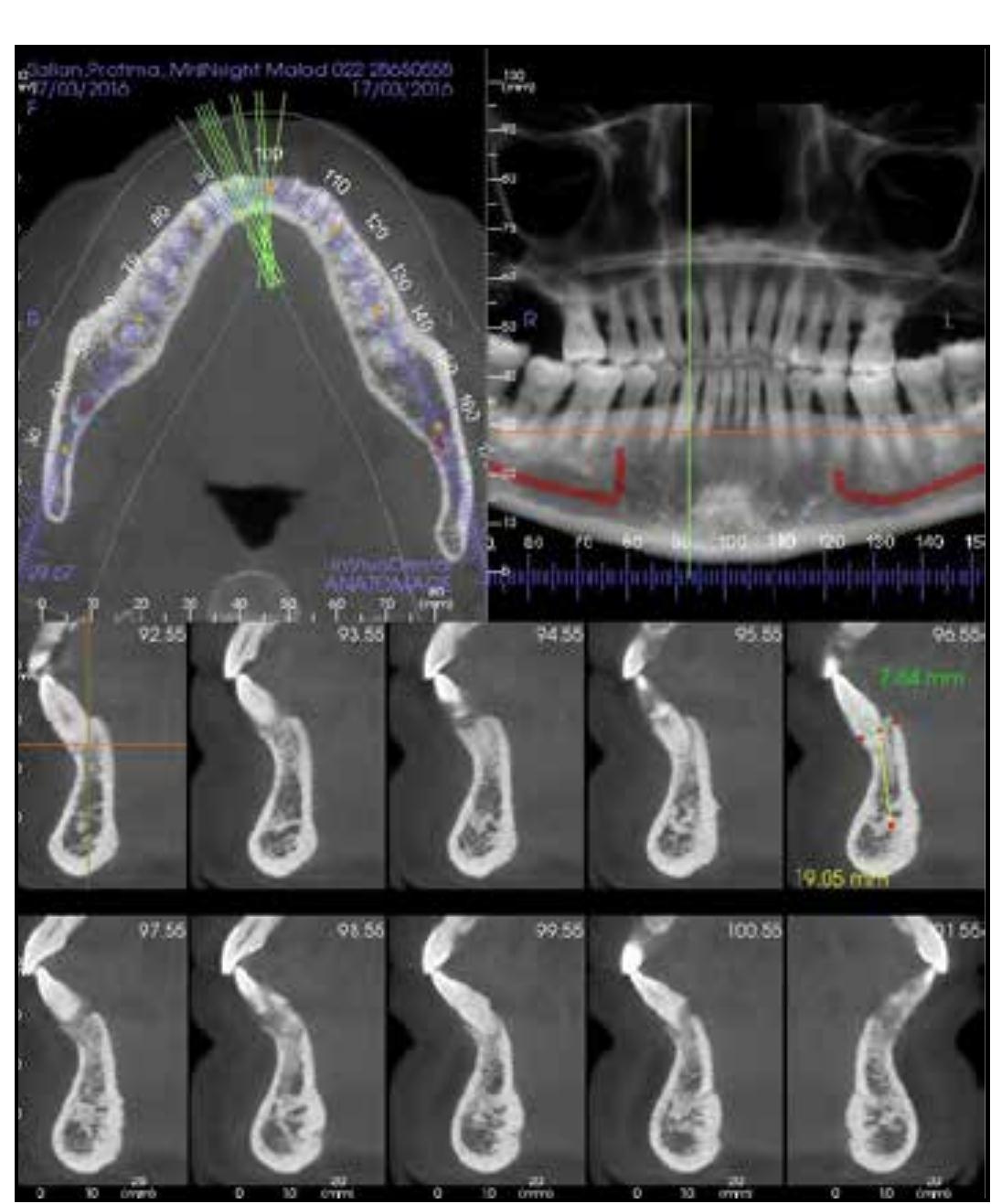 Pre-op clinical view. figure 3: cross section view of cbct.