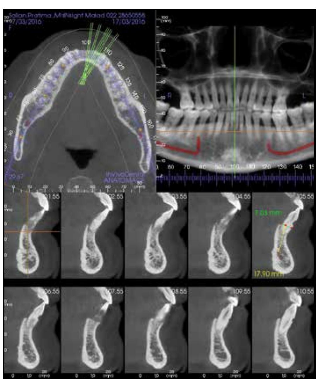 Additional cross section view of cbct.