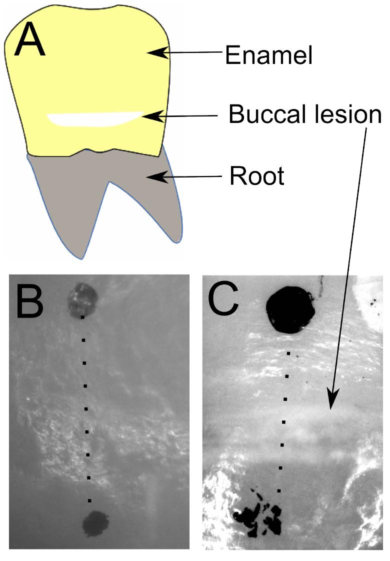 Diagram of a tooth showing a lesion on the buccal surface