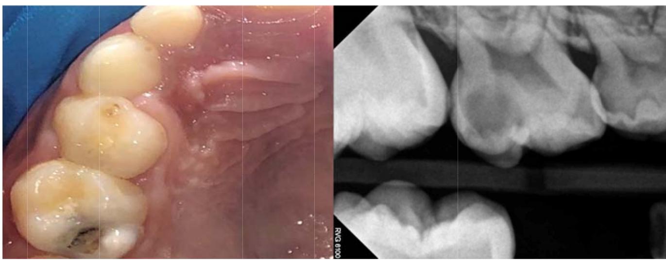 (1). caries risk balance/imbalance. based on young
