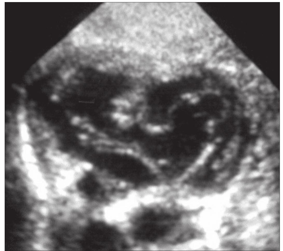 A four -chamber echocardiographic view showing a large inlet